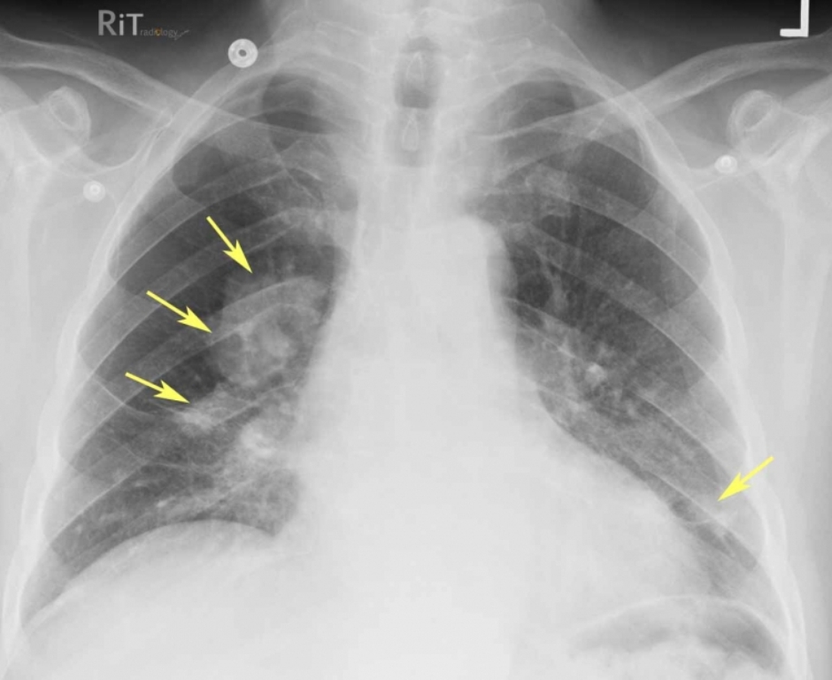 Kanker Paru-paru Dapat Bersembunyi Hingga 20 Tahun