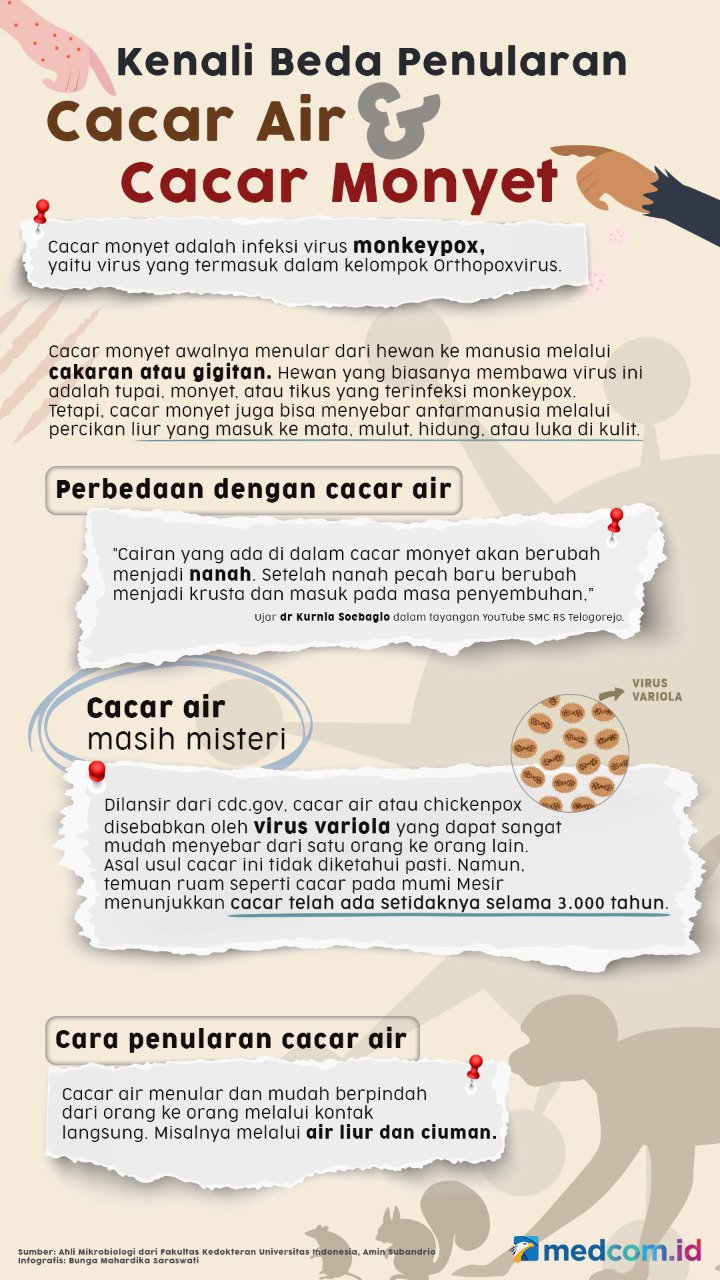 Kenali Beda Penularan Cacar Monyet dan Cacar Air