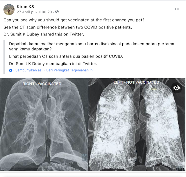 [Cek Fakta] Beredar Foto CT Scan Paru-Paru Pasien setelah Menerima ...